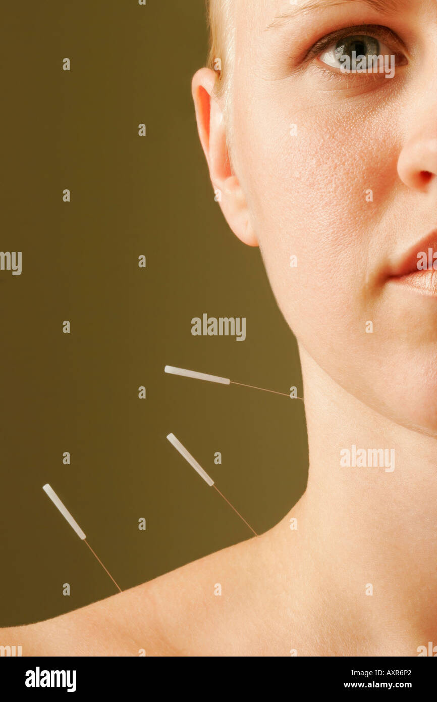 Girl acupuncture hi-res stock photography and images - Alamy