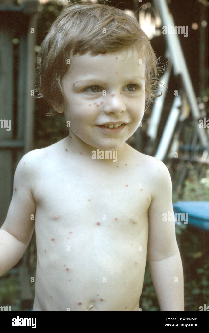 young boy ill with chicken pox Stock Photo - Alamy