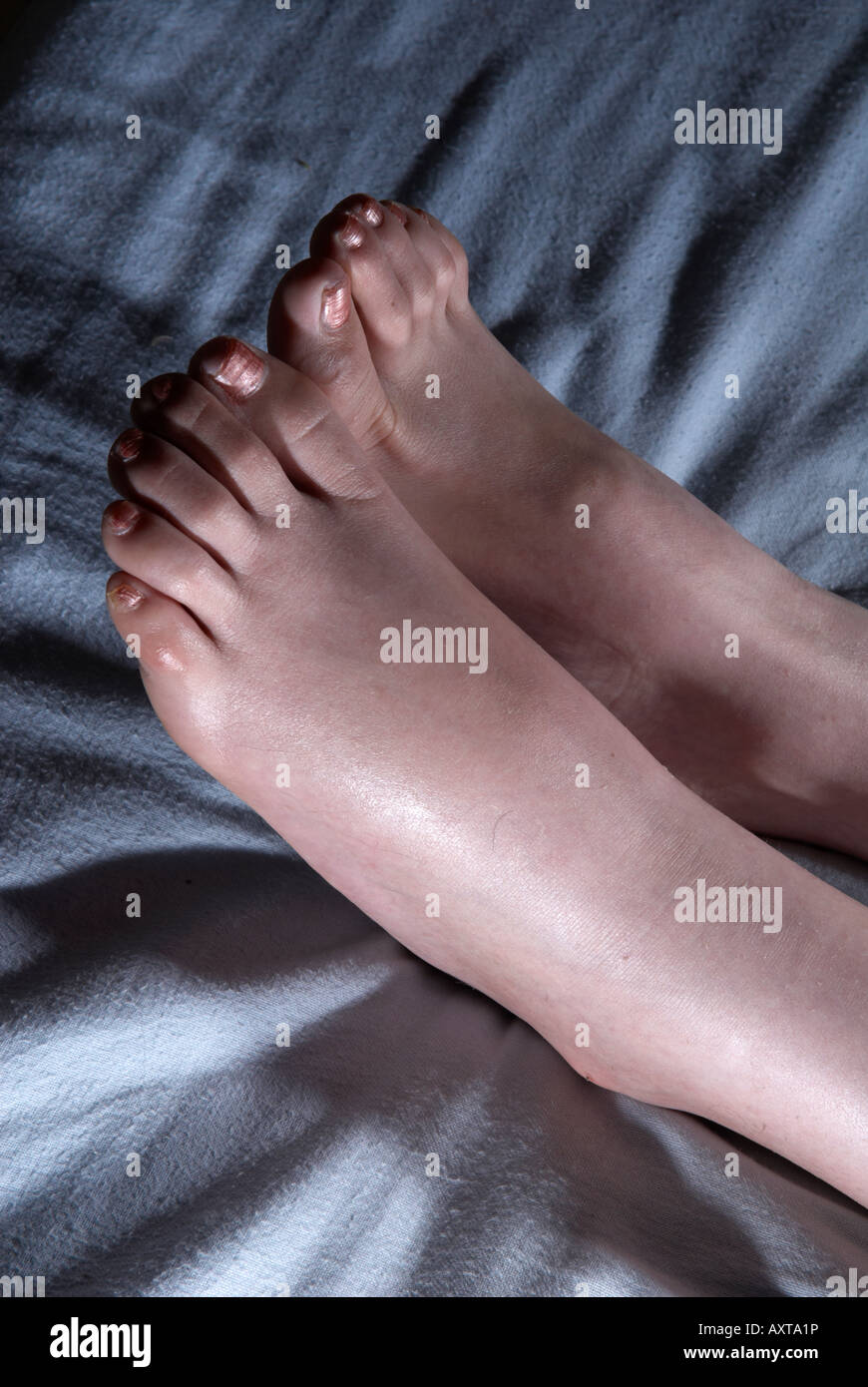 Swollen feet hi-res stock photography and images - Alamy