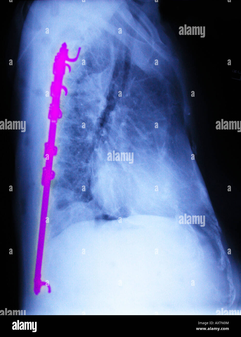 lumbar spine x-ray of a 33 yo female patient with scoliosis showing ...