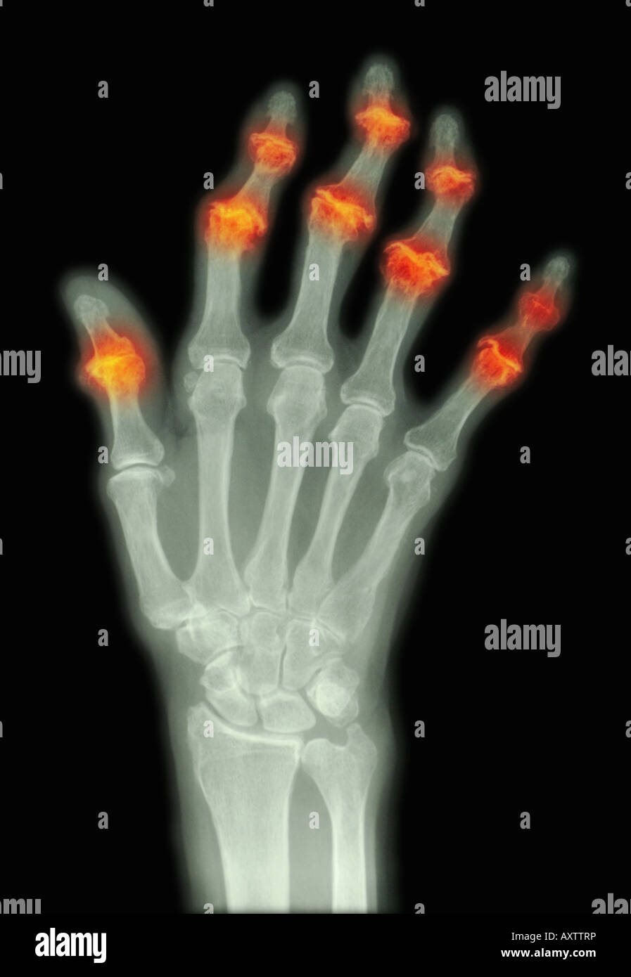 Bouchard hand hi-res stock photography and images - Alamy