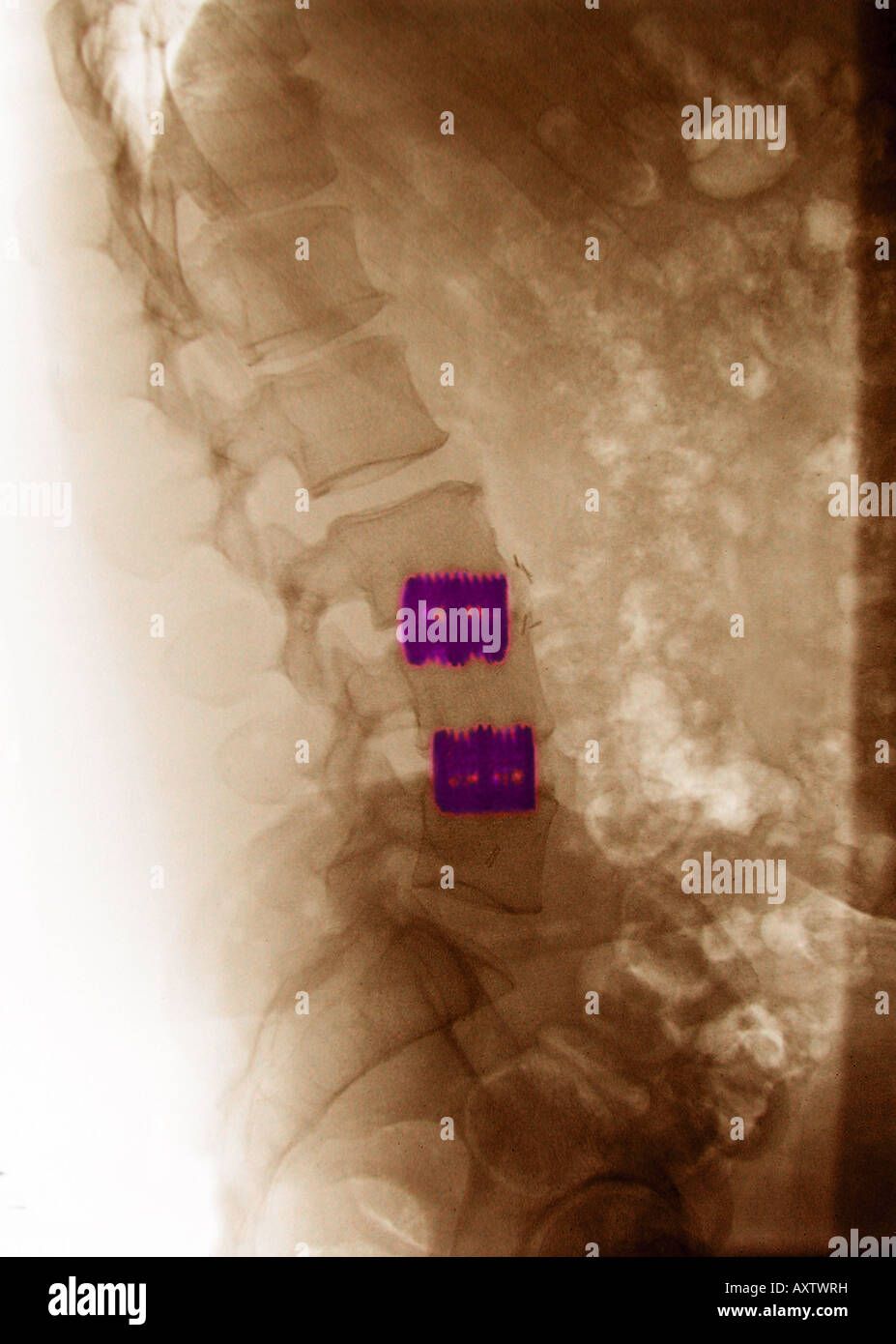 Lumbar spine fusion vertebrae interbody hi-res stock photography and ...