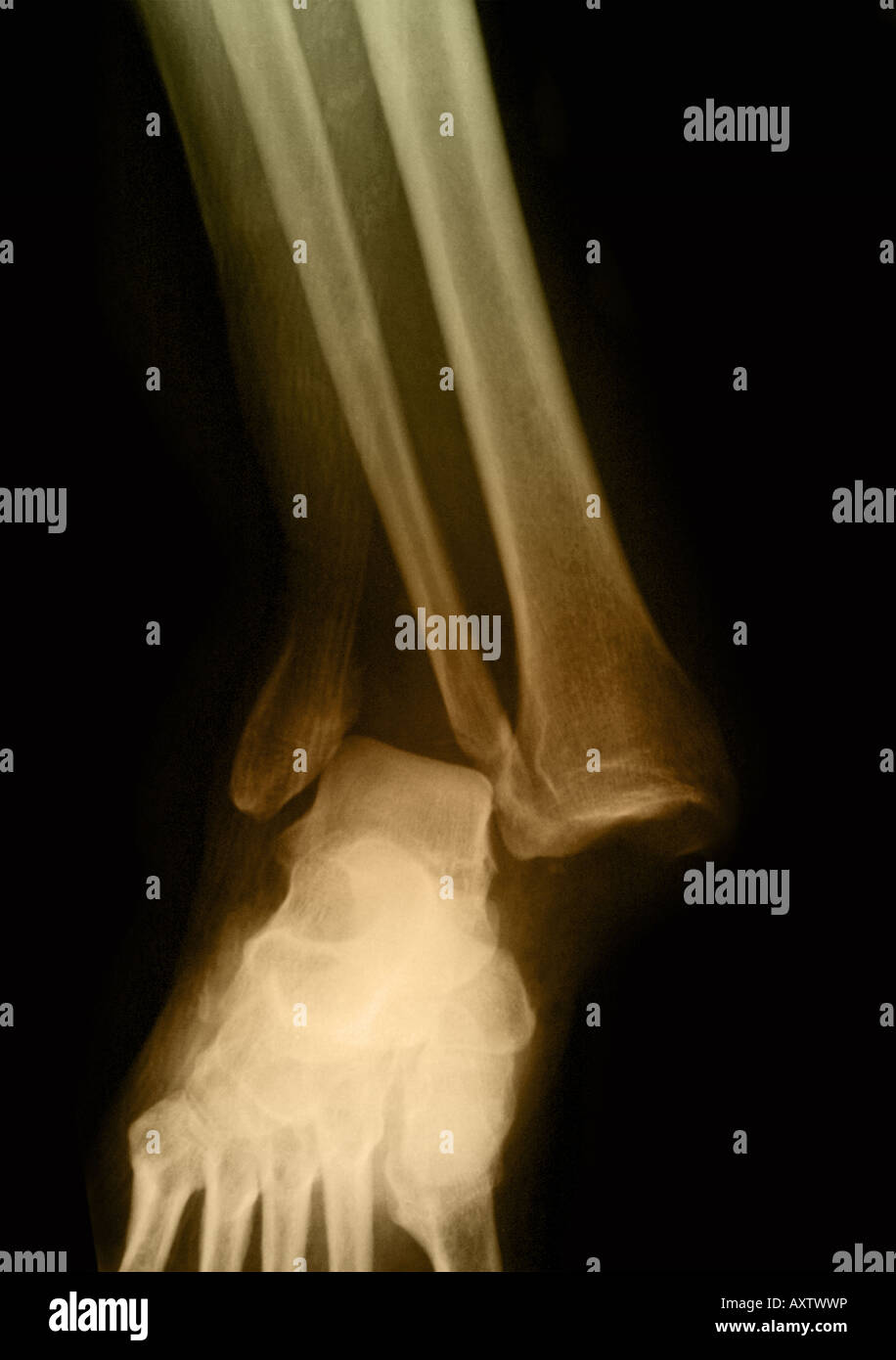 Ankle fracture dislocation colorized hi-res stock photography and ...