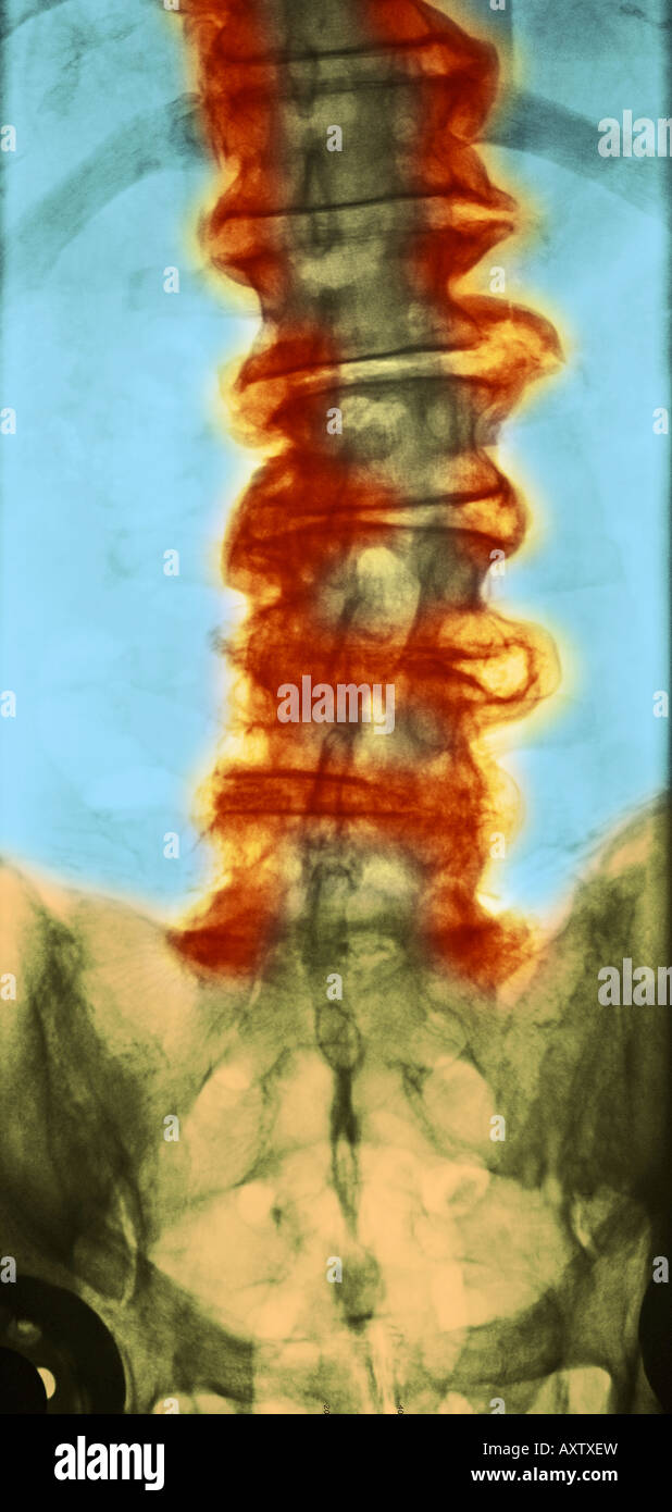 colorized X-ray of the spine showing severe degenerative changes in the ...