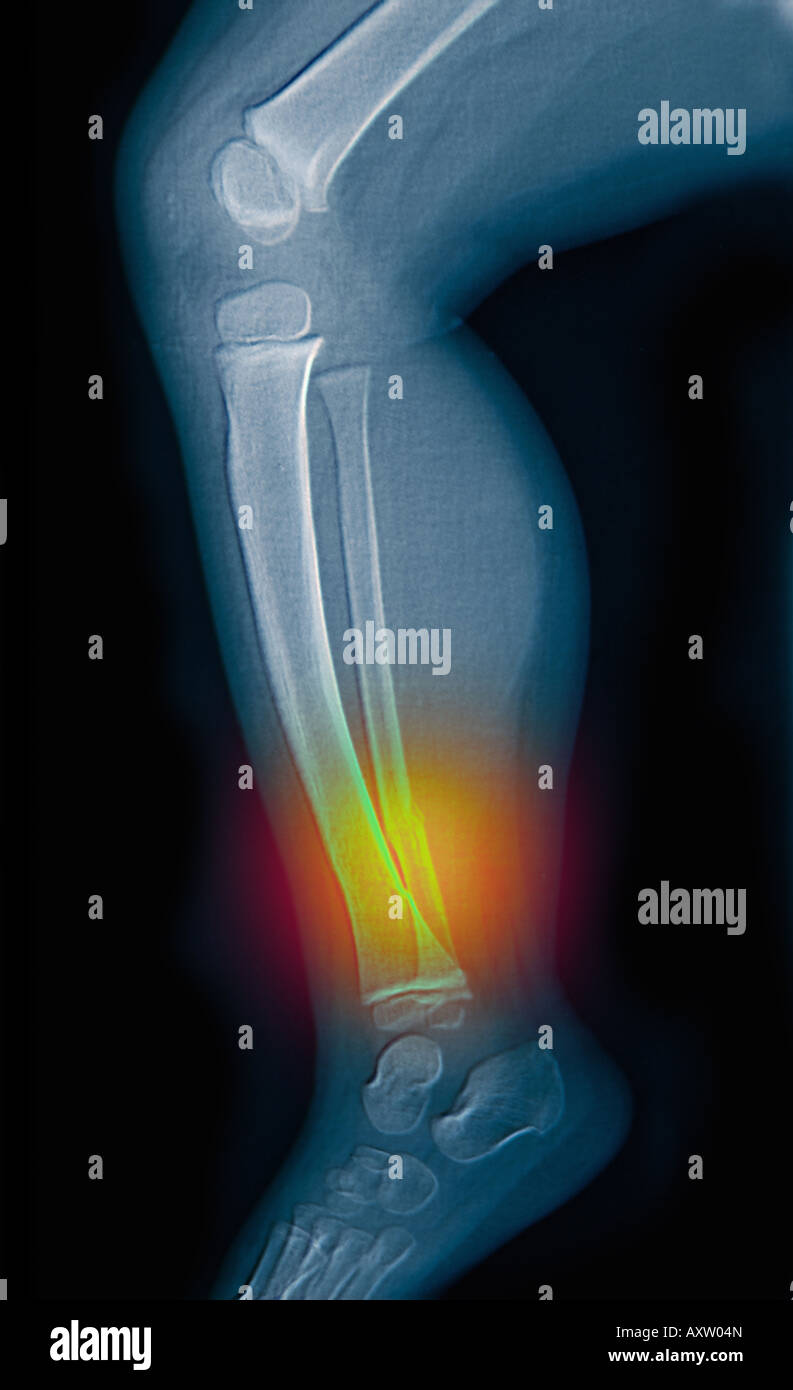 x-ray of the lower leg of a young child showing a fracture from child ...