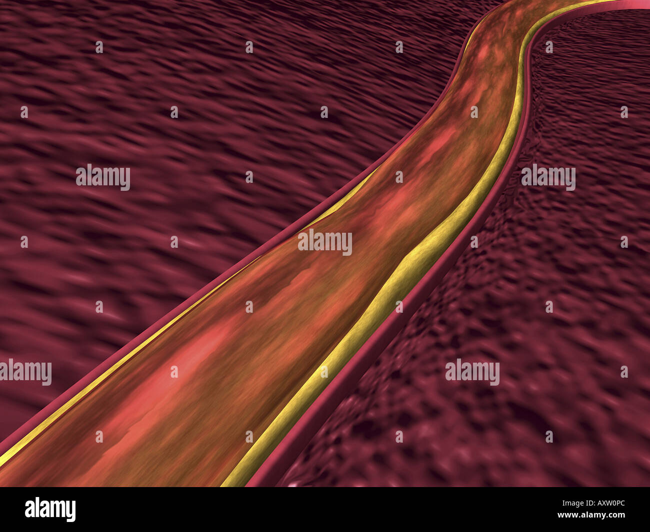 Artery showing Atheroma Stock Photo - Alamy