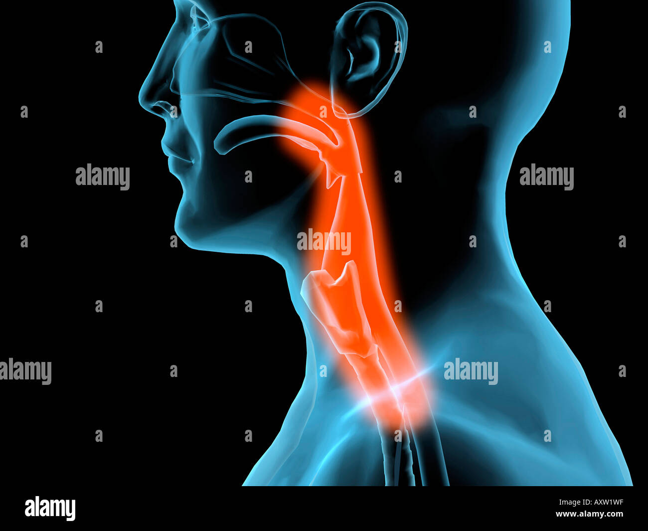 Lingual Tonsil Cancer Pictures