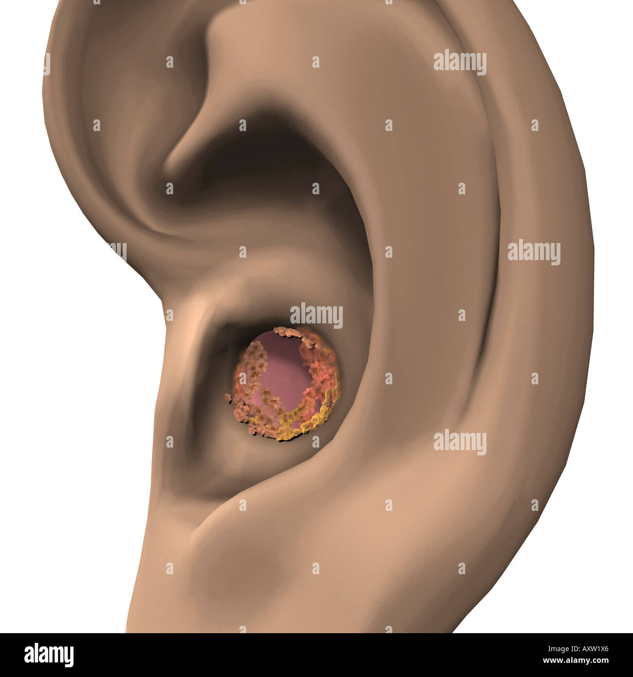 Ear wax anatomy hi-res stock photography and images - Alamy