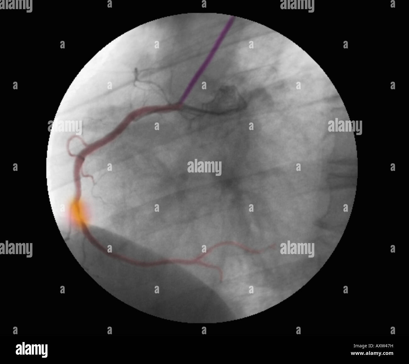 Coronary angiogram hi-res stock photography and images - Alamy