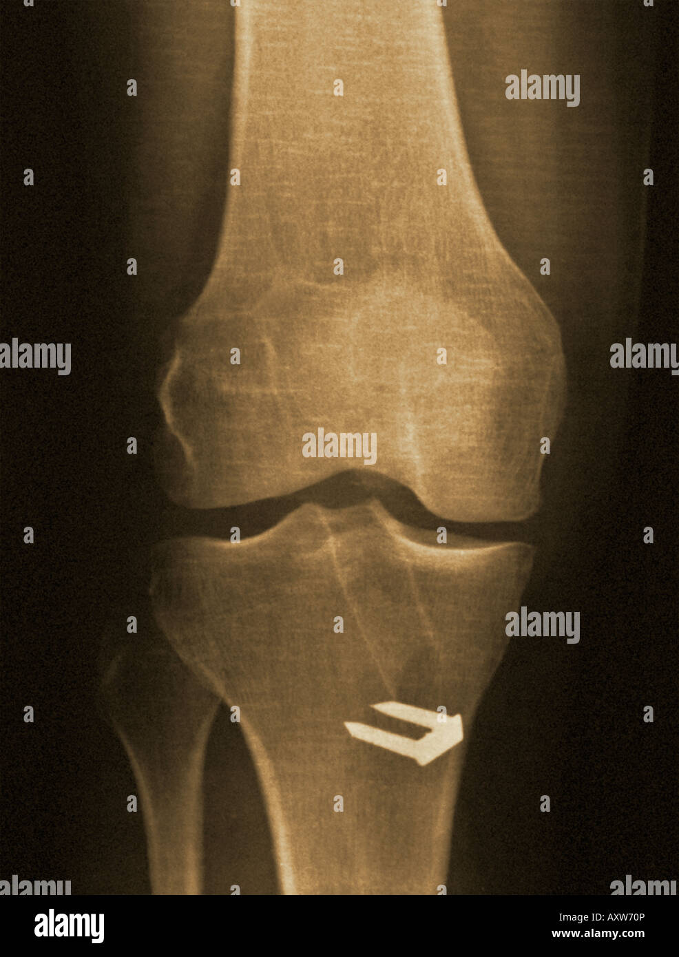 x-ray of the knee of a man who had surgery to repair a ruptured ...