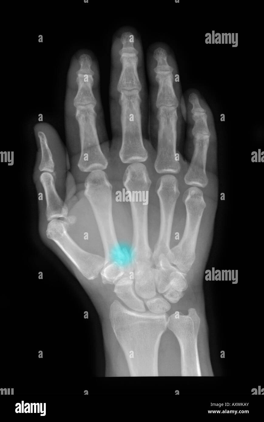 x-ray of the hand of a man with a fracture of the first metacarpal ...