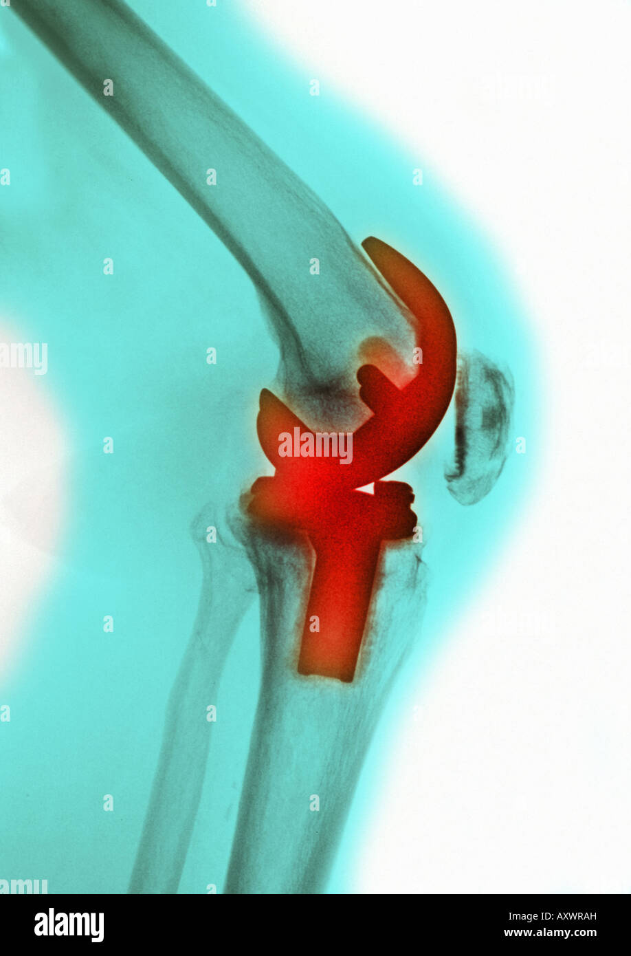 Degenerative joint disease hi-res stock photography and images - Alamy