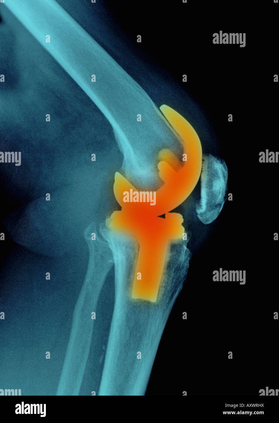 digitally enhanced colorized x-ray showing a knee replacement in a 79 ...