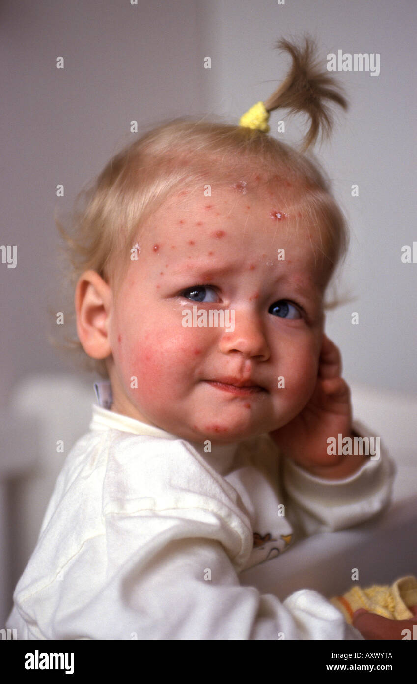 Little girl with chicken pox Stock Photo - Alamy