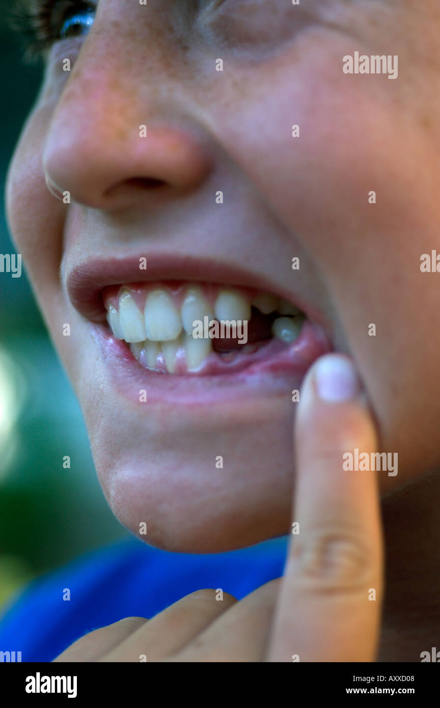 Missing toothless facial hi-res stock photography and images - Alamy