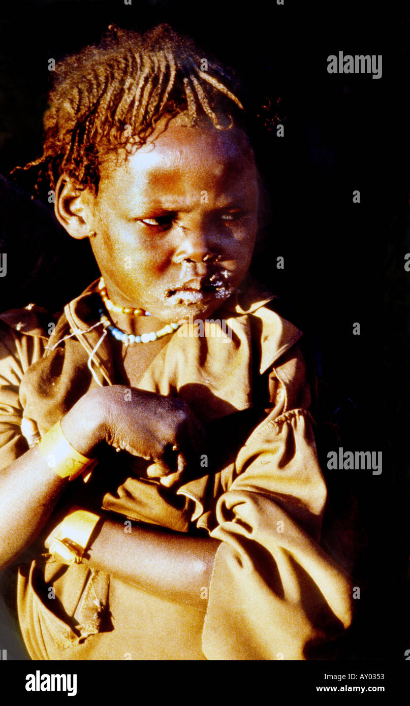 Marasmus hi-res stock photography and images - Alamy