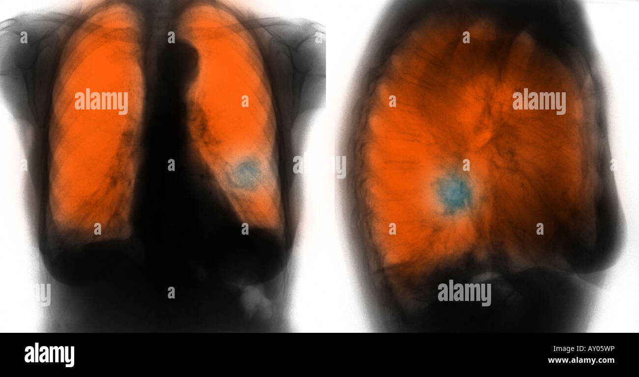 chest x-ray shwoing COPD (chronic obstructive pulmonary disease) and ...