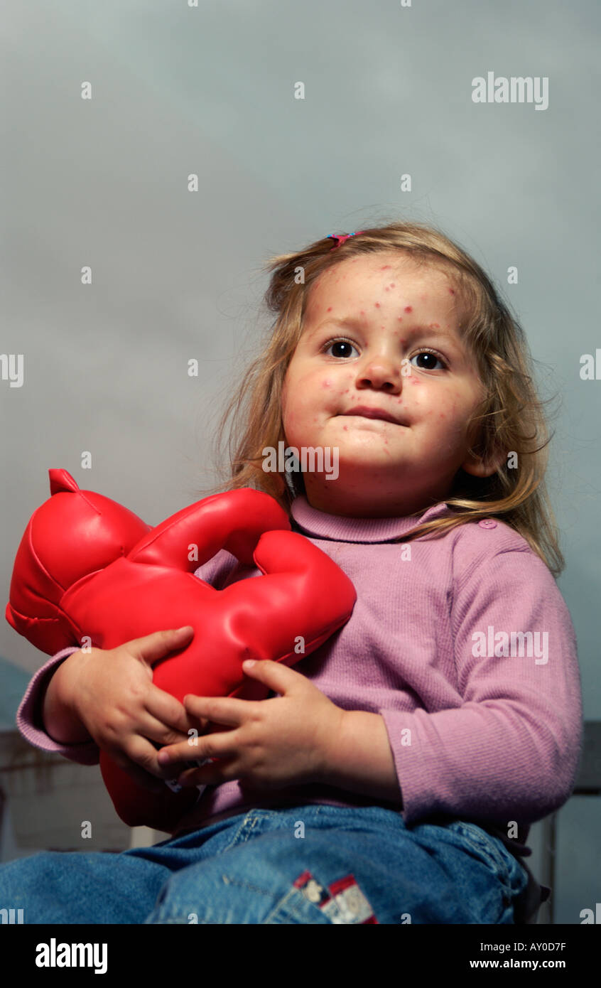 girl chicken pox Stock Photo - Alamy