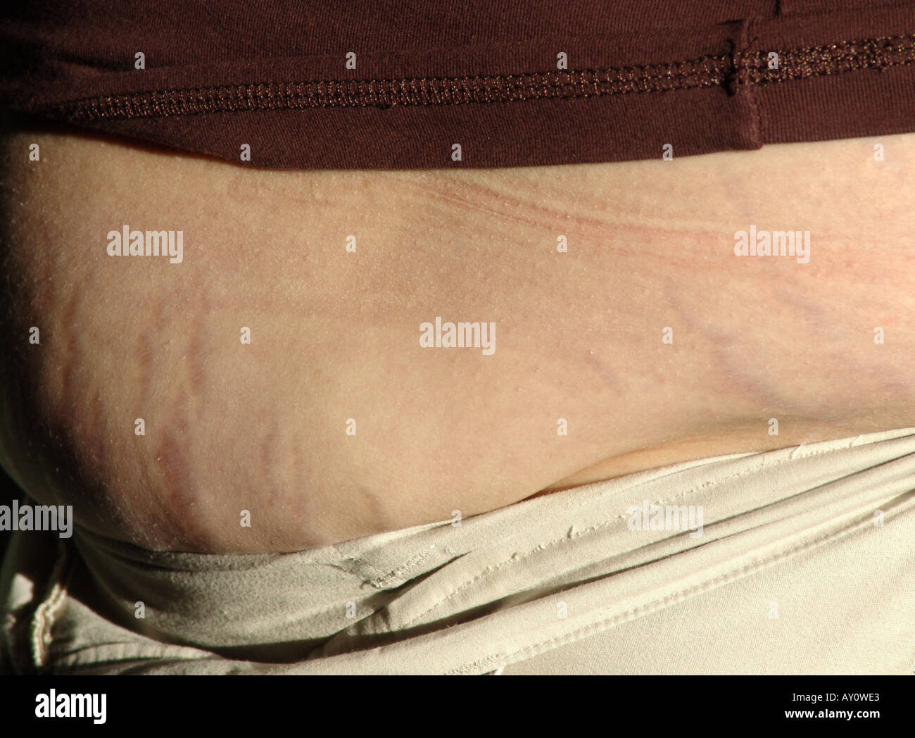 Striae syndrome hi-res stock photography and images - Alamy