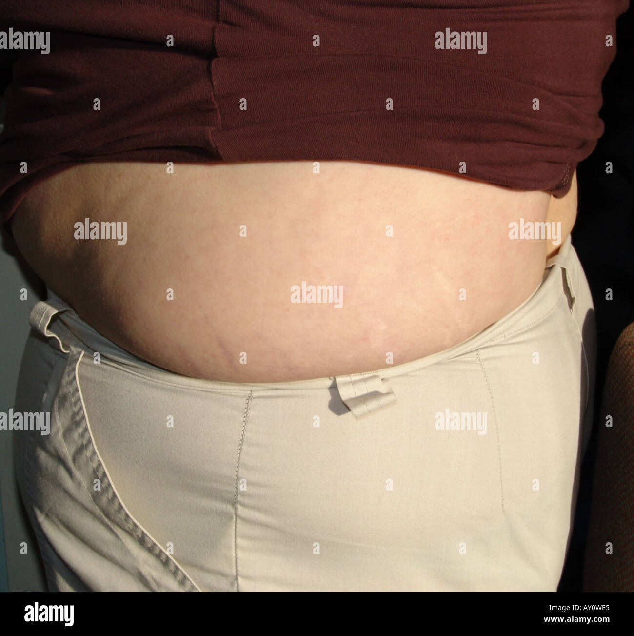 Skin stretch marks GB UK 2005 Stock Photo - Alamy
