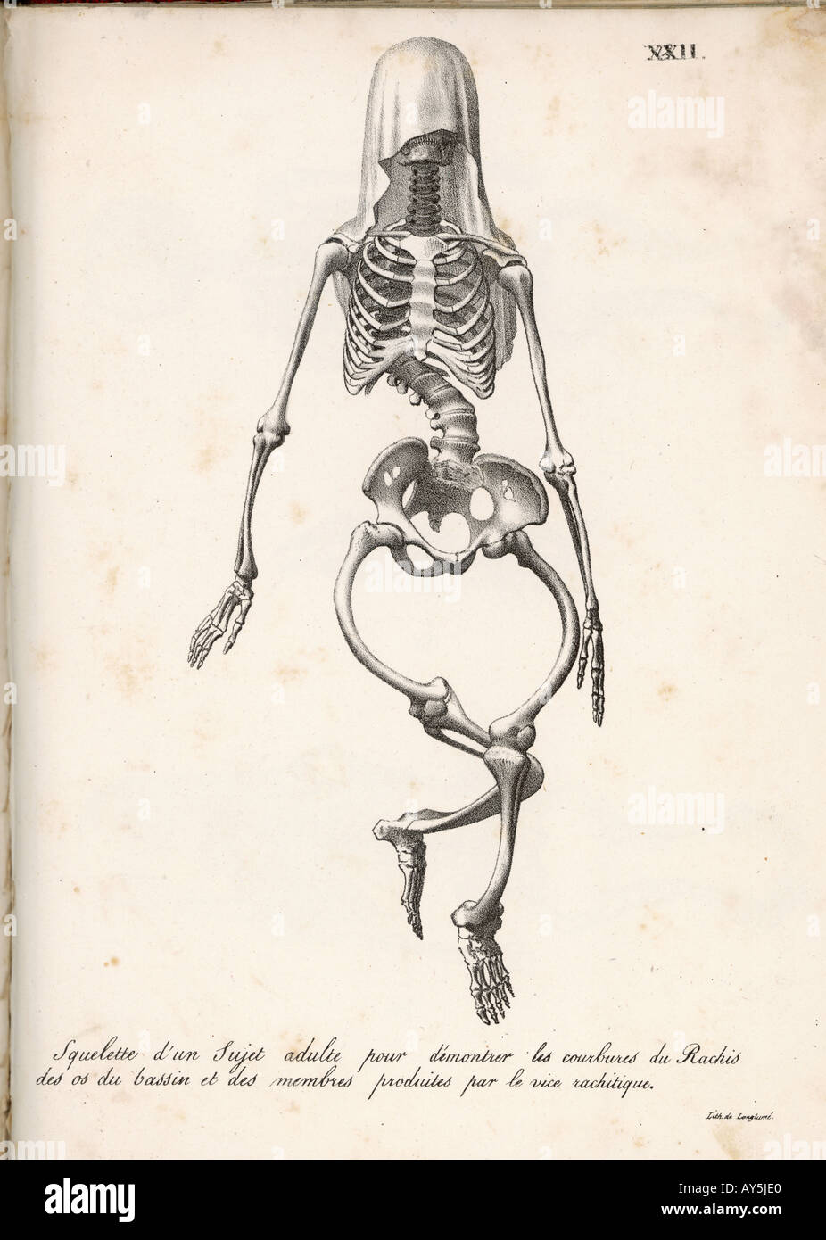 Skeleton Of Rickets Stock Photo - Alamy