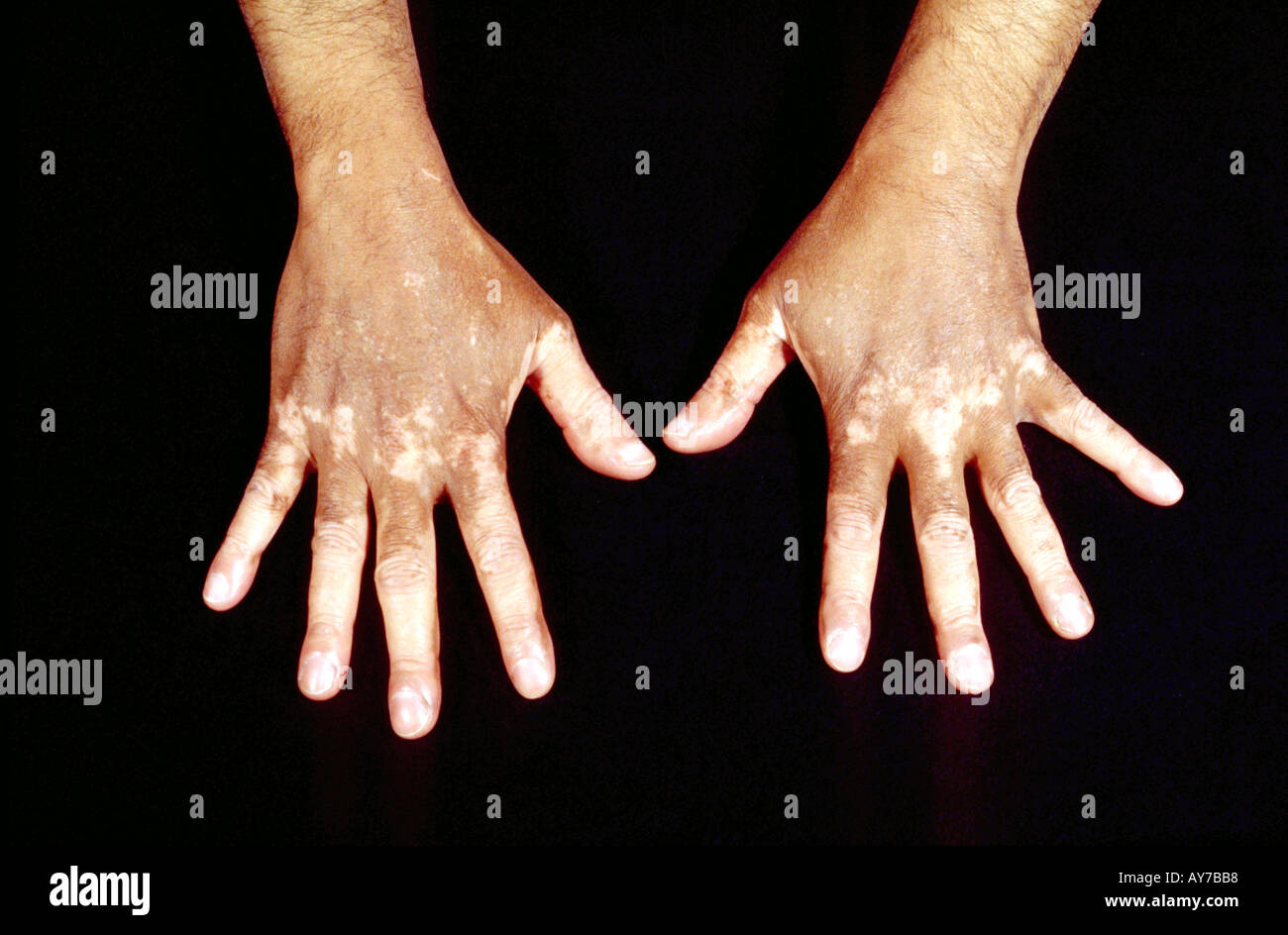 Contact dermatitis exposure to hydroquinone Stock Photo - Alamy
