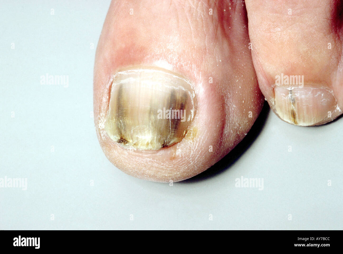 Tinea unguium hi-res stock photography and images - Alamy