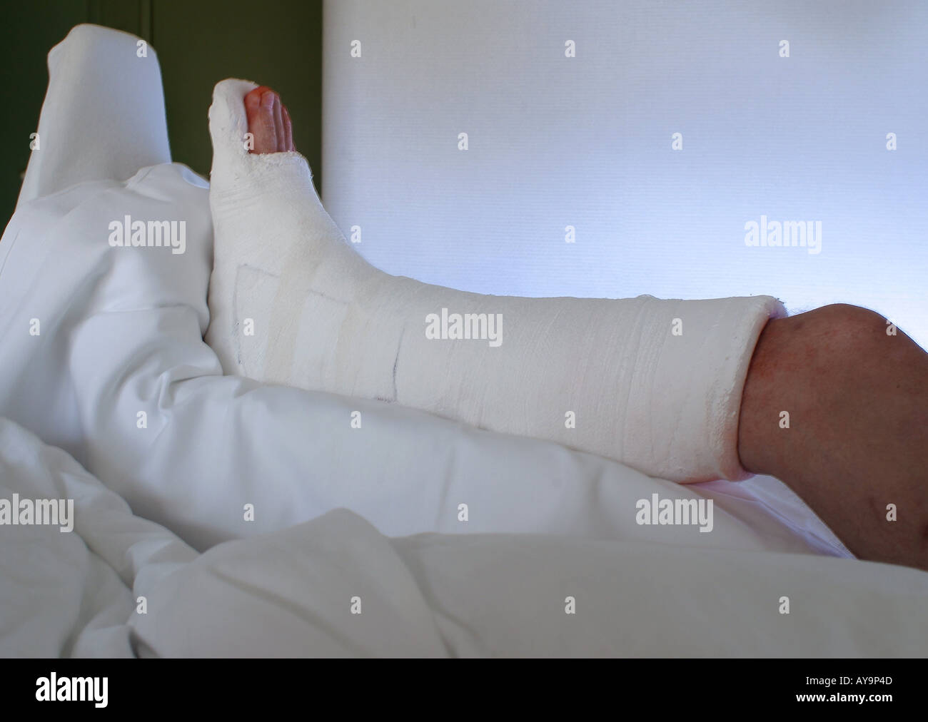 Gipsbein High Resolution Stock Photography and Images - Alamy