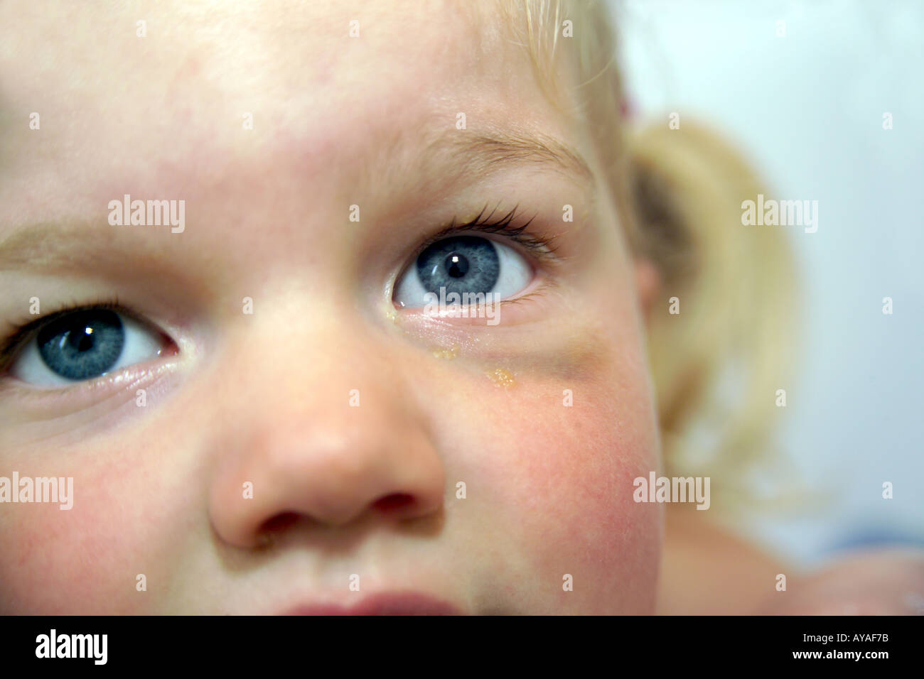 Child black and blue bruise hi-res stock photography and images - Alamy