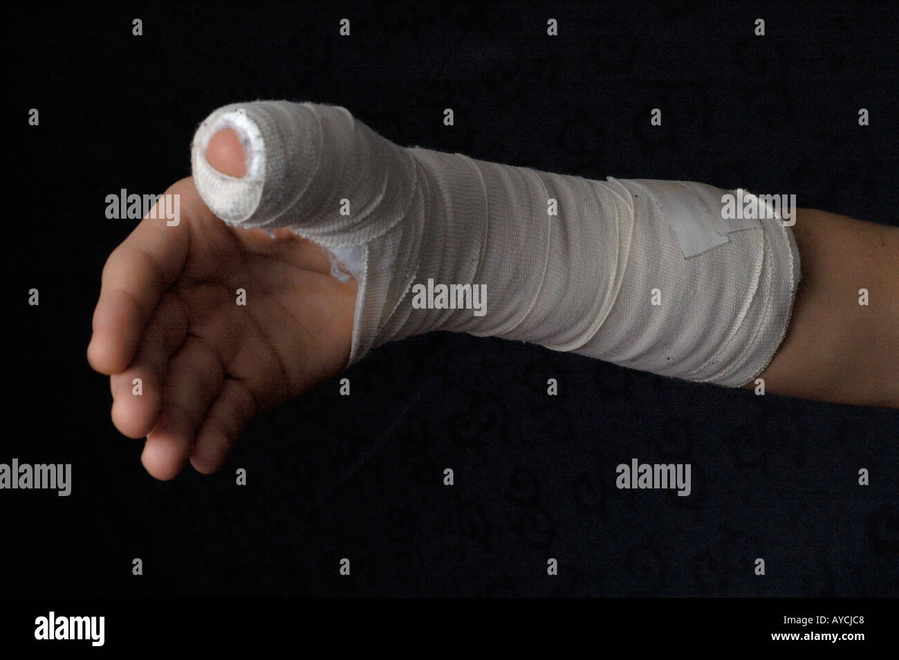 Hand in plaster bandage Stock Photo - Alamy