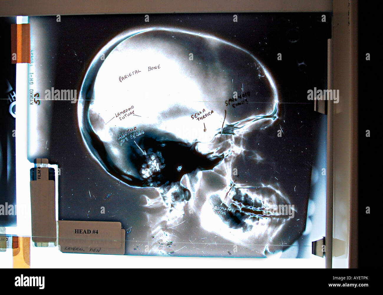 x ray of scull and neck Stock Photo - Alamy