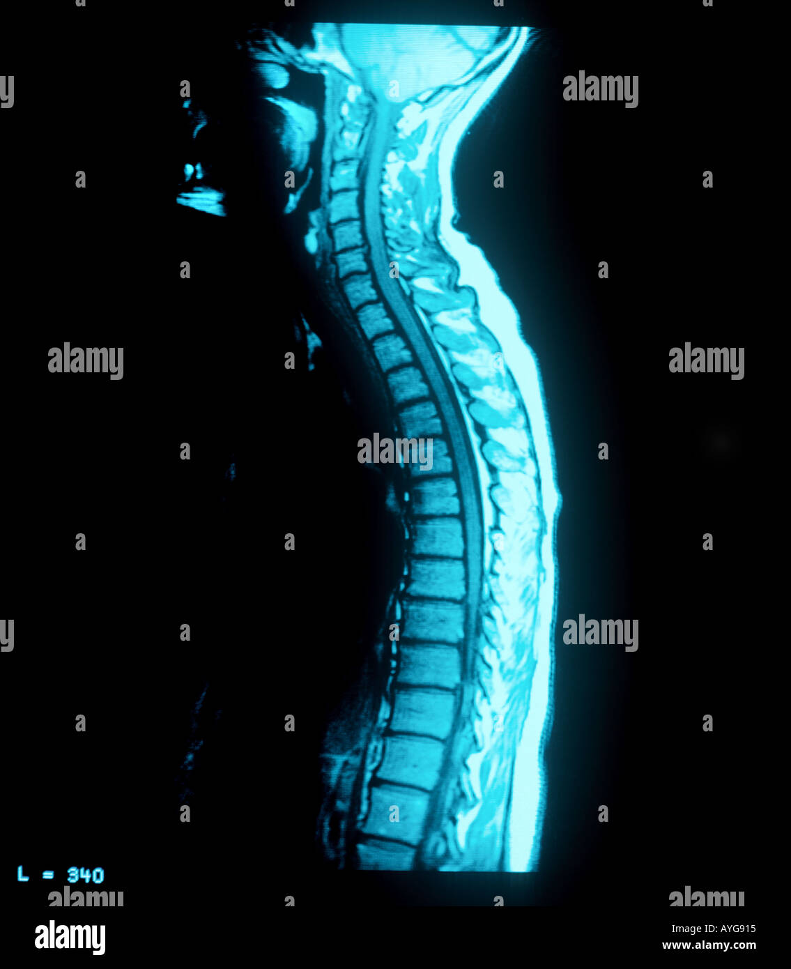Mri neck spine hi-res stock photography and images - Alamy