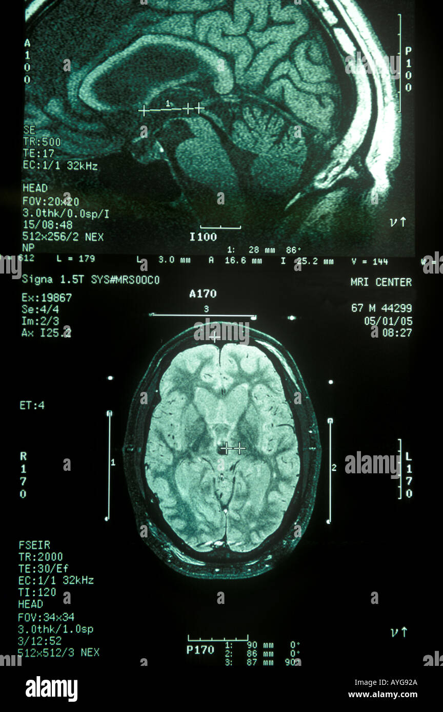 Human brain mri Stock Photo - Alamy