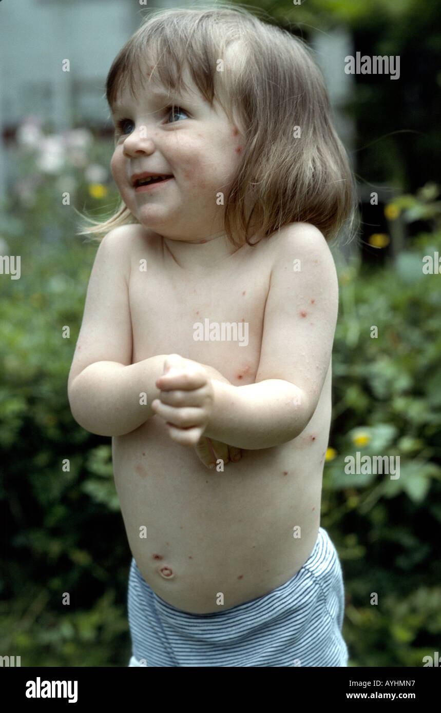 young child suffering with chickenpox Stock Photo - Alamy