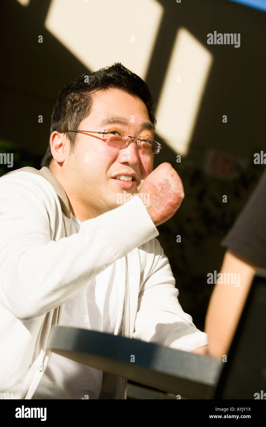 Man with disfigured hand Stock Photo - Alamy