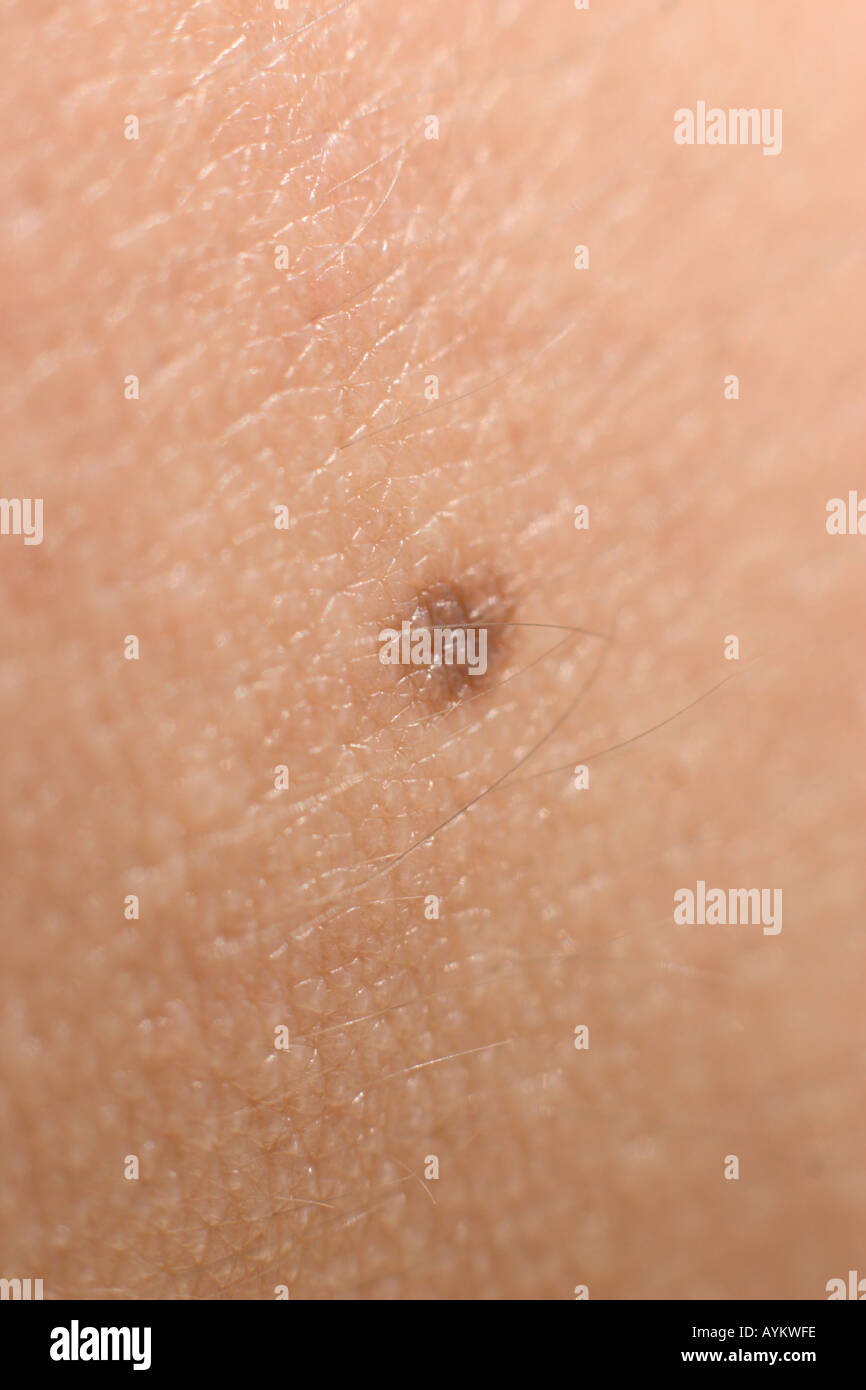 Naevus hi-res stock photography and images - Alamy