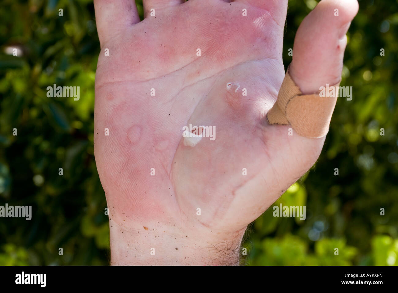 Friction blister hi-res stock photography and images - Alamy