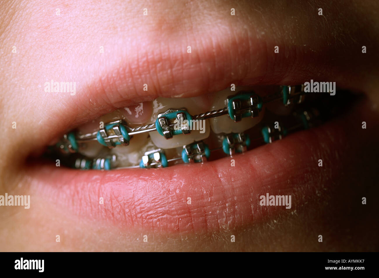 teeth brace blue bands metal lips skin dental ortho orthodontic repair ...