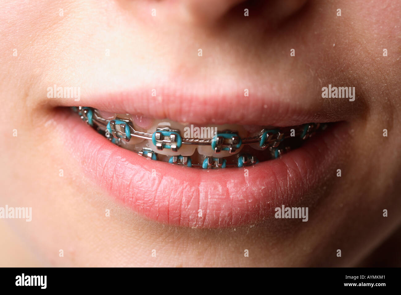 teeth brace blue bands metal lips skin dental ortho orthodontic repair ...