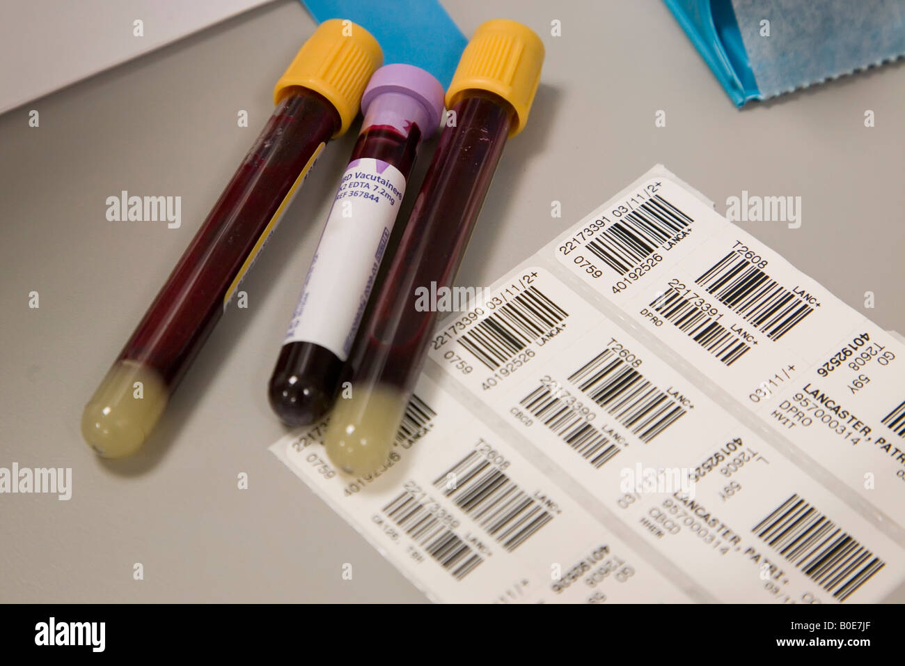 Blood of patient participating in clinical trial of new cancer ...