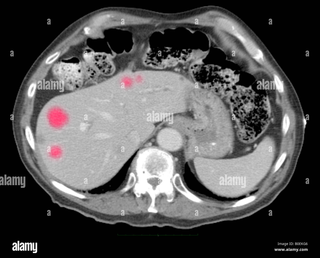 Liver Cancer Ct Scan