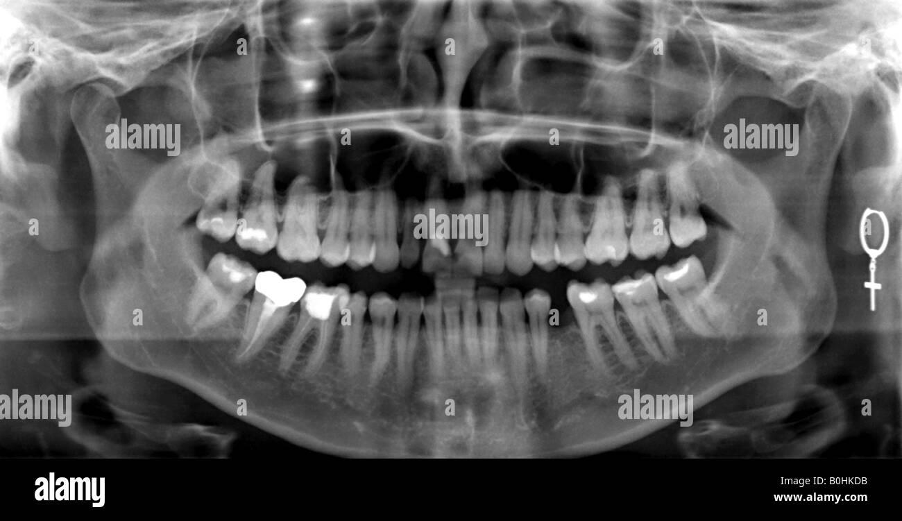 Hamular Notch Radiograph