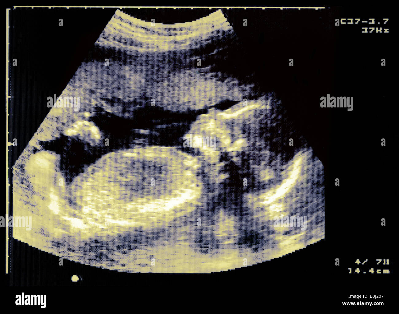 Ultrasound fetus hi-res stock photography and images - Alamy