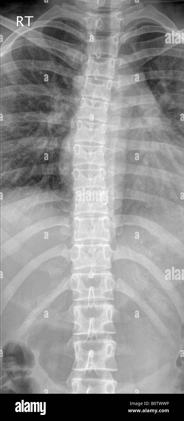 X ray of a normal female spine and rib cage Stock Photo - Alamy