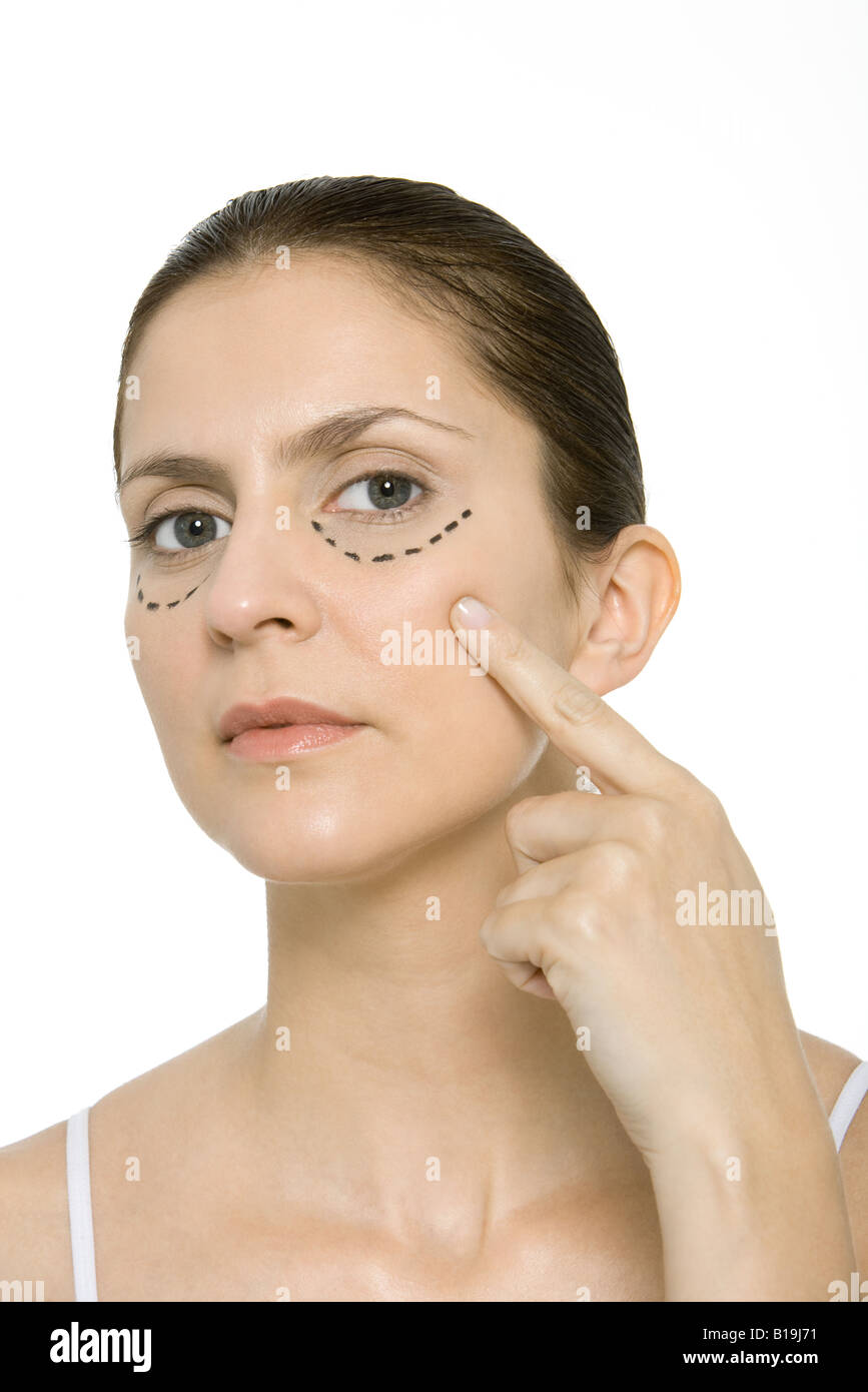 Woman pointing at plastic surgery markings on cheek, looking at camera ...