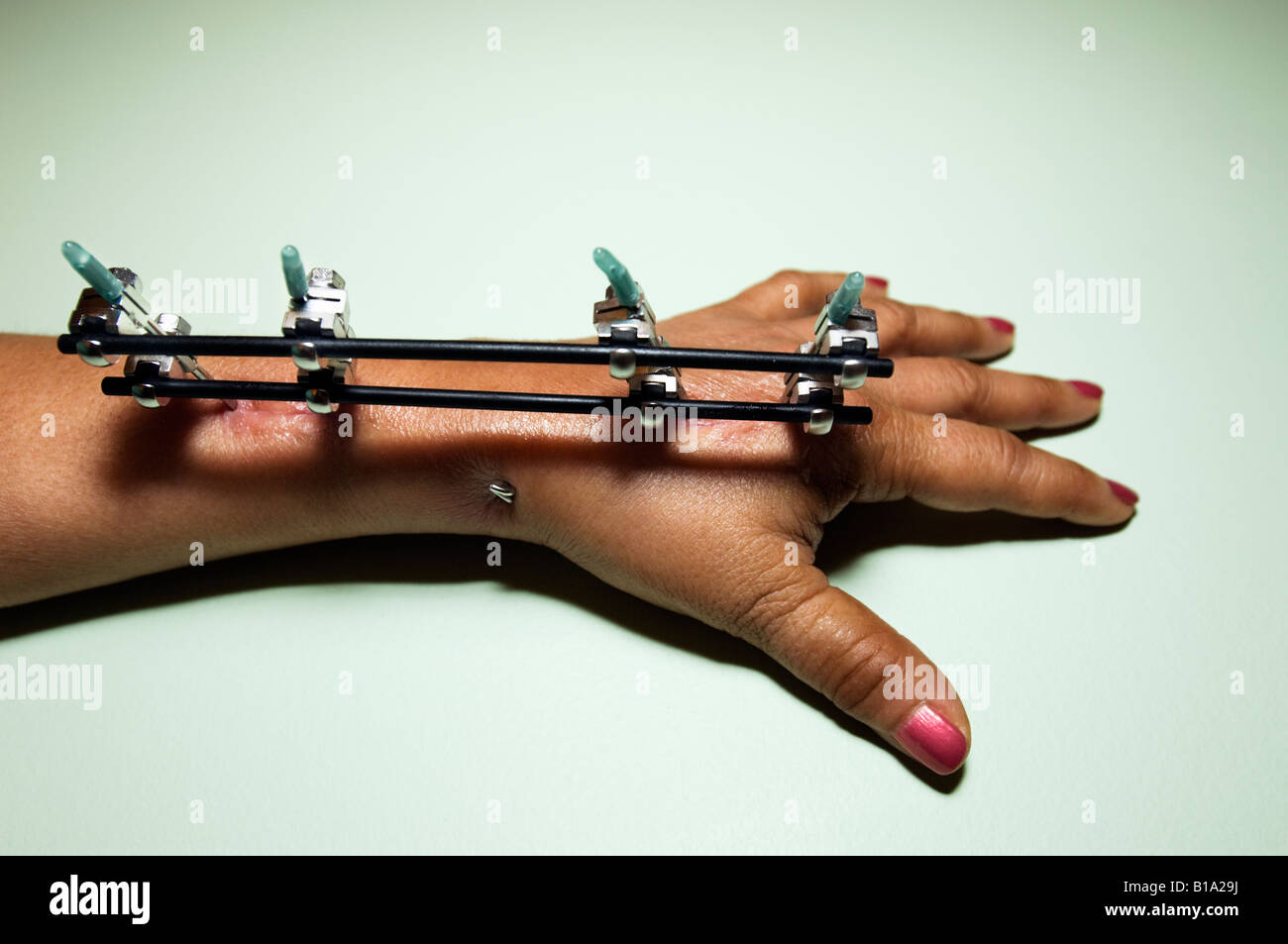 Distal radius fracture hi-res stock photography and images - Alamy