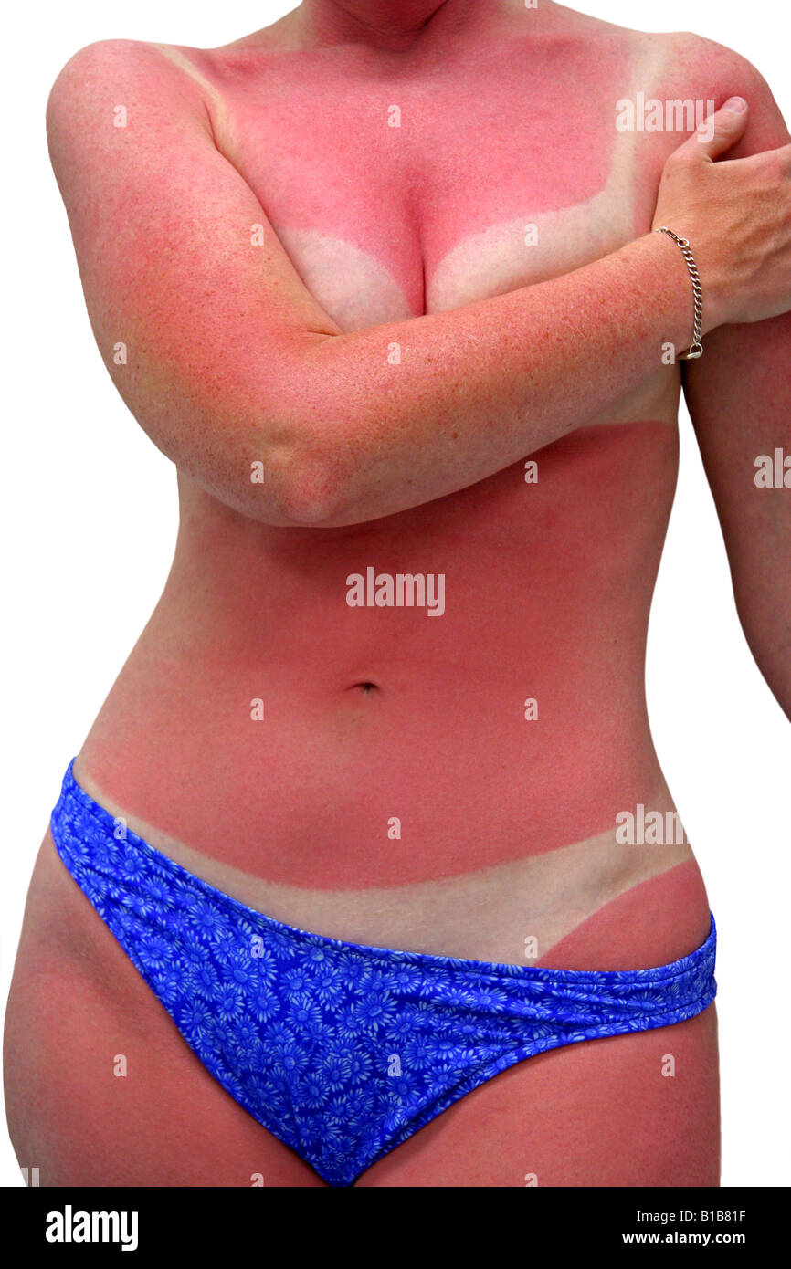 A Woman S Body With A Bad Case Of Sunburn Isolated On White Background And Includes Clipping