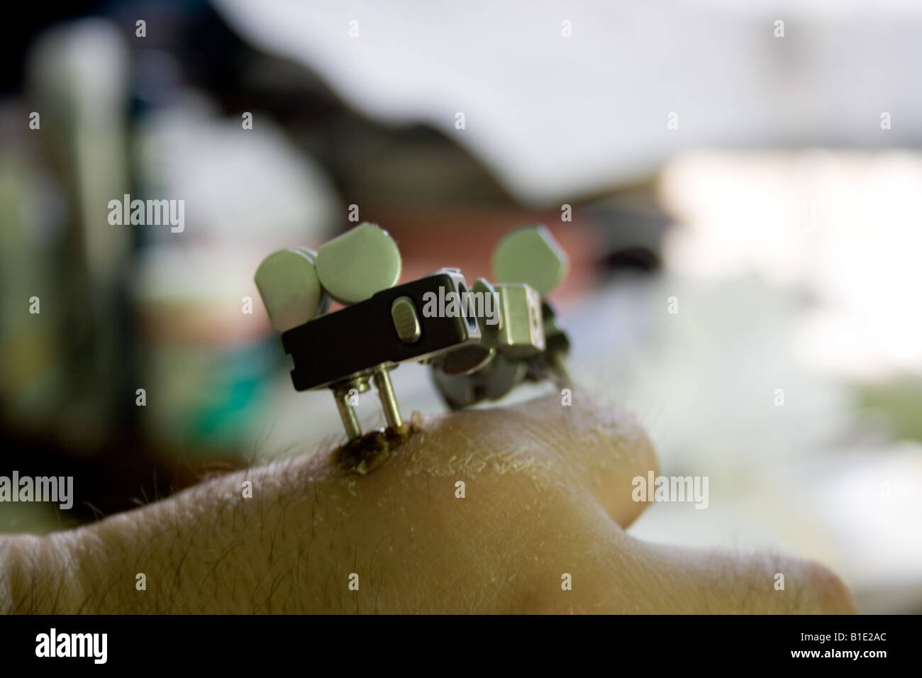 External fixator on Fractured little finger on left hand Stock Photo ...