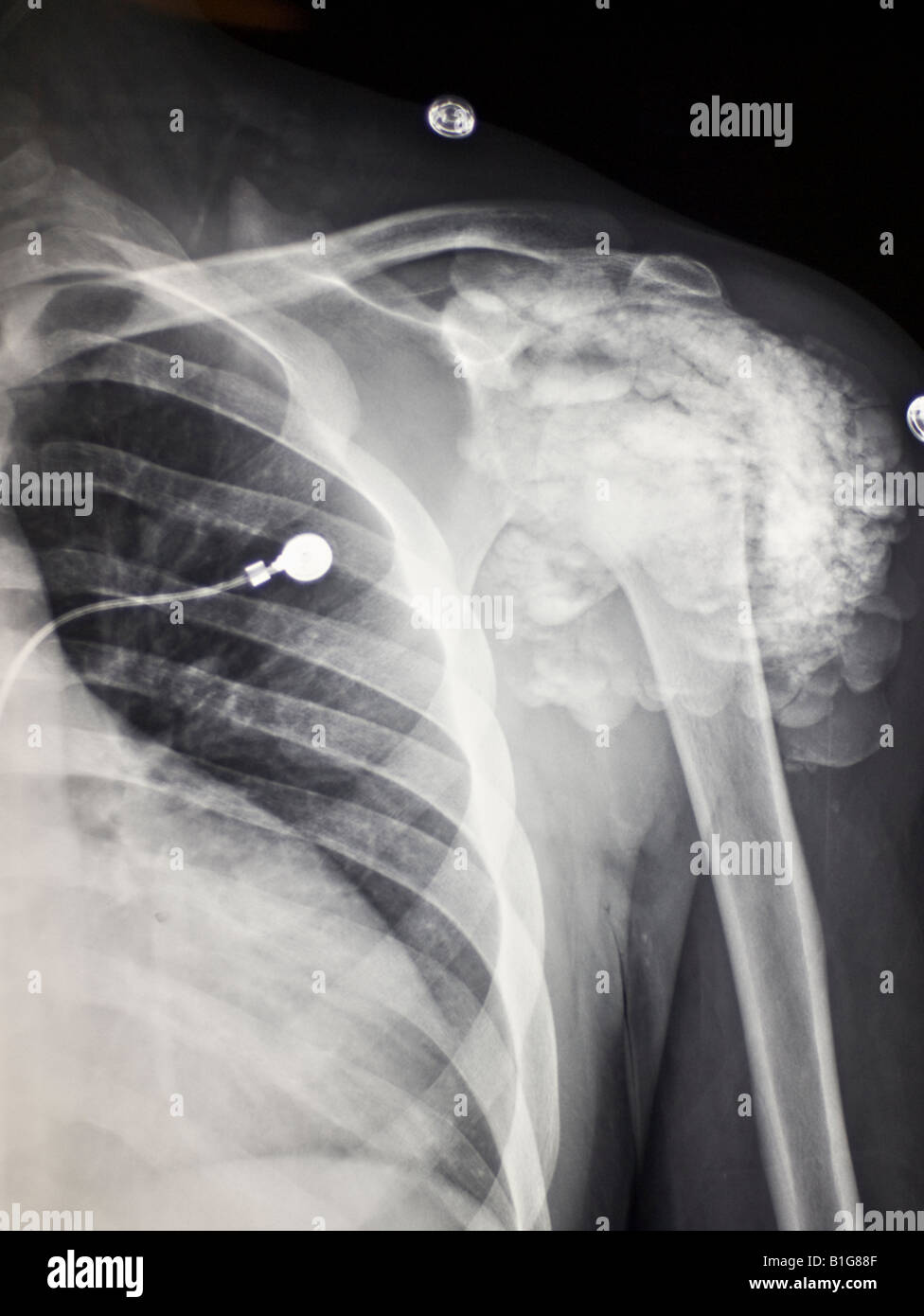 Ectopic calcification hi-res stock photography and images - Alamy