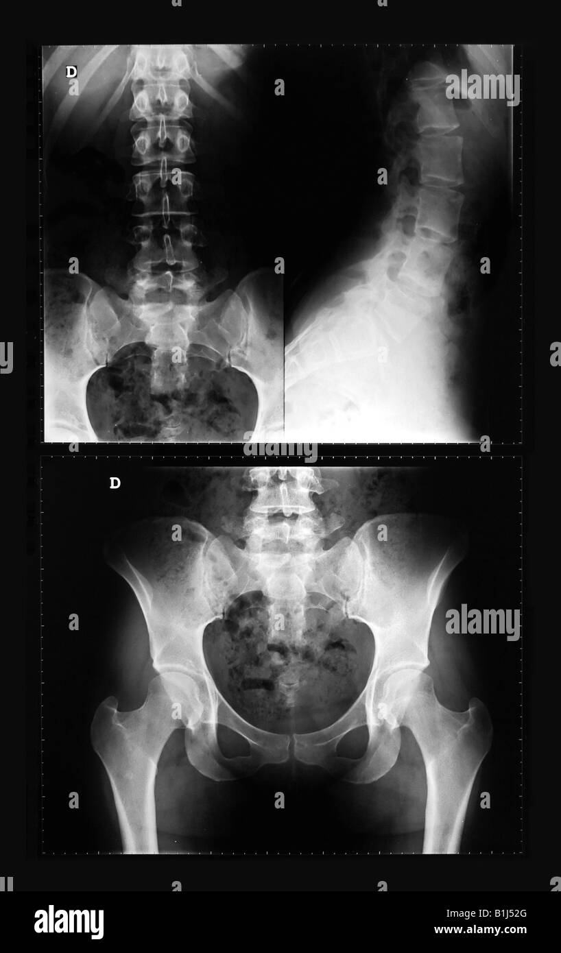 X-ray of the spinal column and pelvis of a woman Stock Photo - Alamy